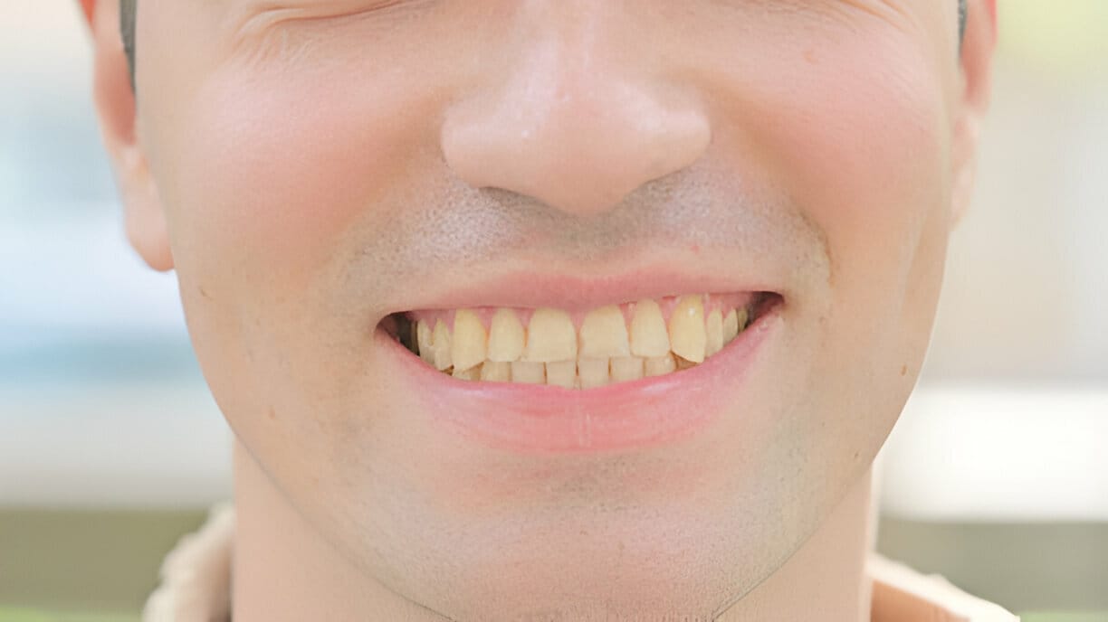 Why Are My Teeth Discolored? Common Causes and Fixes - Dr. Kamila ...